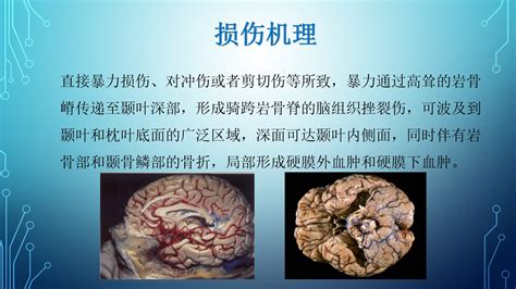 颞叶脑挫裂伤手术治疗策略 脑医汇 神外资讯 神介资讯