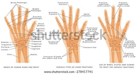 Various Types Hand Fractures Fractures Both Stock Vector Royalty Free 278417741 Shutterstock