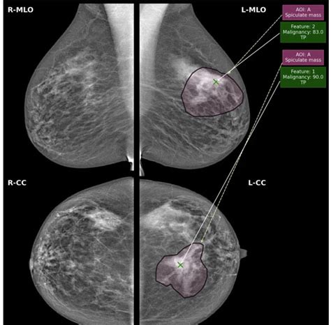 Considering Breast And Lesion Level Assessments With Mammography Ai What New Research Reveals