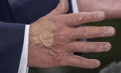 Trump Is Seen With Make Up On His Hand Ahead Of Uk Visit Weeks After He