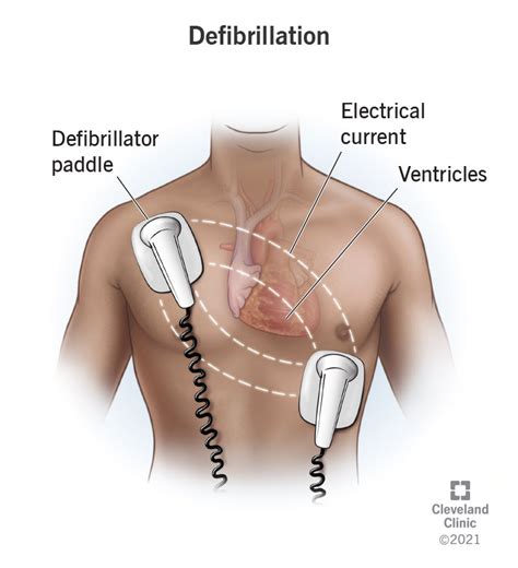 Automated External Defibrillator Pad Placement