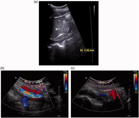Inferior Vena Cava Ultrasound After 2 Years Of Follow Up Shows Good