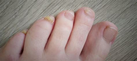 Macro Close Up Of A Fungal Nail Infection Onychomycosis On Toes