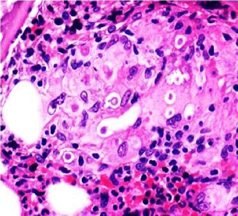 Granuloma With Spores Of Cryptococcus In A Hiv Positive Patient