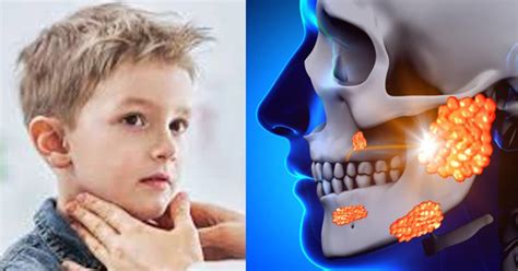 Mumps Cases Surge In Delhi And Ncr Signs Symptoms And Ways To Keep