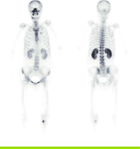 The Bone Scan Of The Whole Body Initial Bone Scan Shows Increased Download Scientific Diagram