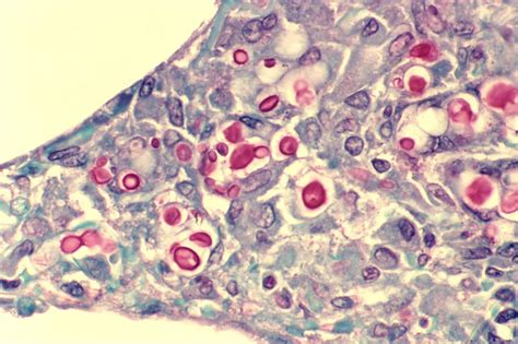 Cryptococcus Neoformans Wiktionary
