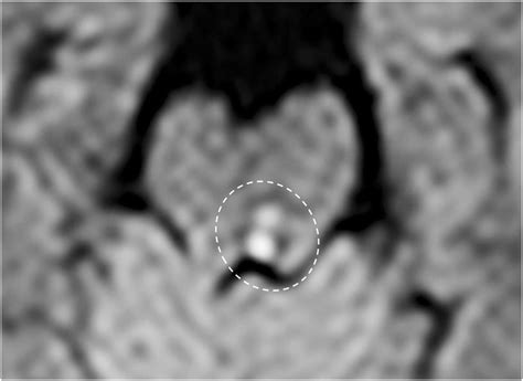 Ischämie Des Nucleus Nervi Trochlearis Pacs
