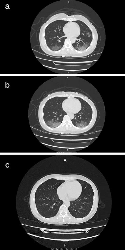 A B Ct Images Reveal Multifocal Ground Glass Opacities With