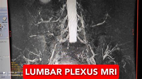 Lumbosacral Plexus Mri Protocols And Planning