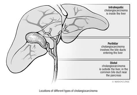 Cholangiocarcinoma Diagram