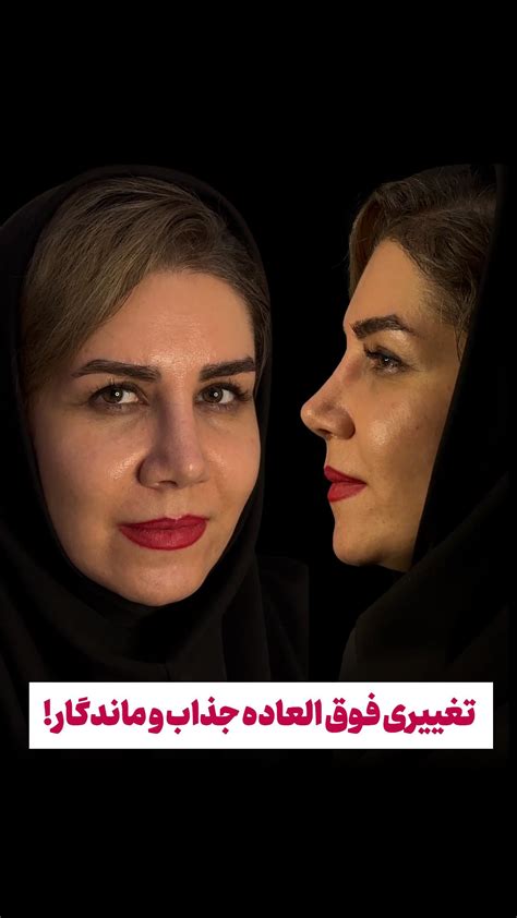 ‎دکتر مهدی محمودی جراح بینی‎ ‎من مشکل تنفسی دارم میتونم بینیم رو عمل