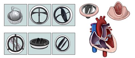 심장판막수술 시술수술안내 일반인정보 심장병원 서울아산병원