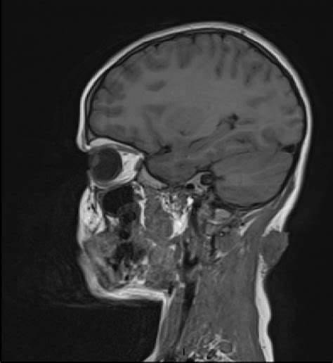 Rare Case Of Multiple And Perforating Pilomatrixomas In A Young Girl With Lymphovascular