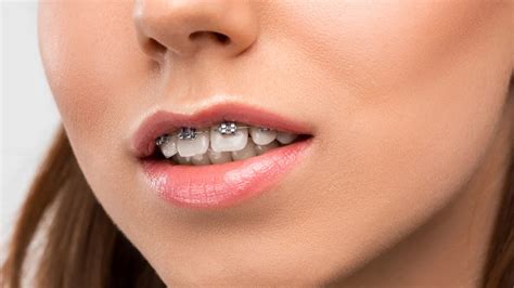 Buck Teeth Overbite Causes Risks And Treatment Options Quest