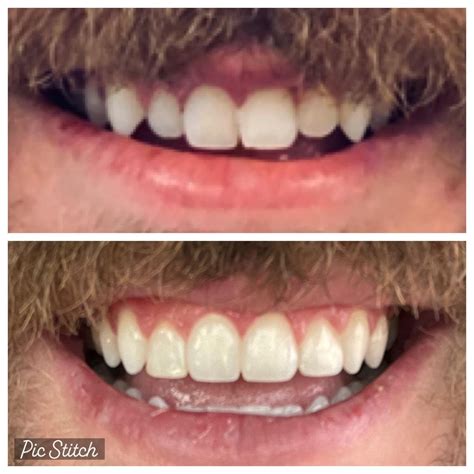 My Ortho Wants To Extract My Wisdom Teeth But I Dont Like That Idea Please Share Your