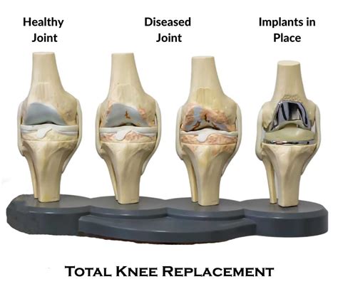 Doctors Advice Knee Replacement Quill Orthopaedic Specialist Centre