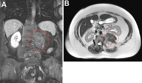 Coronal A And Axial B Mri With Contrast Showing A Retroperitoneal