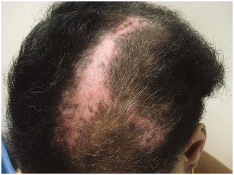 Discoid Lupus Erythematosus Scalp