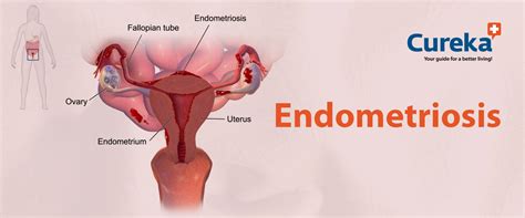 Endometriosis Cureka