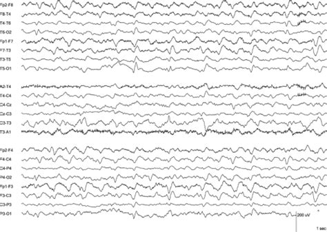 Triphasic Pattern Neupsy Key Triphasic Pattern Neupsy Key