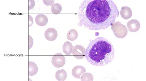Monoblast Vs Myeloblast
