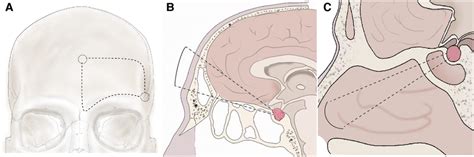 Schema Of The Unilateral Subfrontal Approach And Etsa A The Bone Download Scientific Diagram