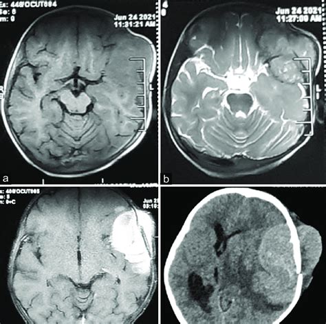 Case 2 A T1 Weighted Image Showing An Isointense Sol In The Left