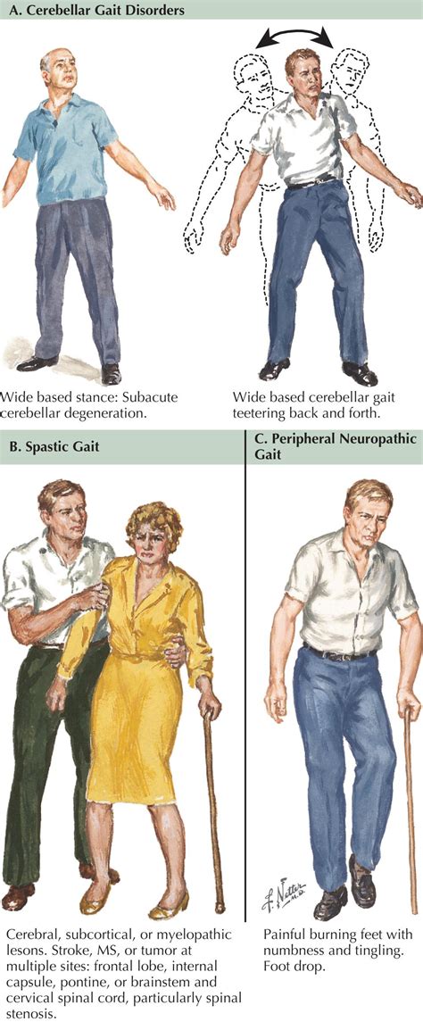 Gait Disorders Clinical Tree