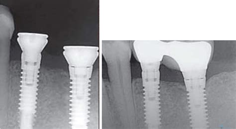 Soft Tissue Implant Integration Part 3
