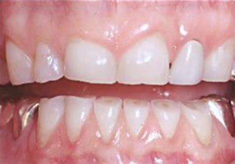 Distribution And Impact Of Oral Cancer And Non Carious Tooth Loss