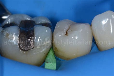Simplifying Posterior Restorations Clinical Performance Of Filtek™ Easy Match Composite Resin