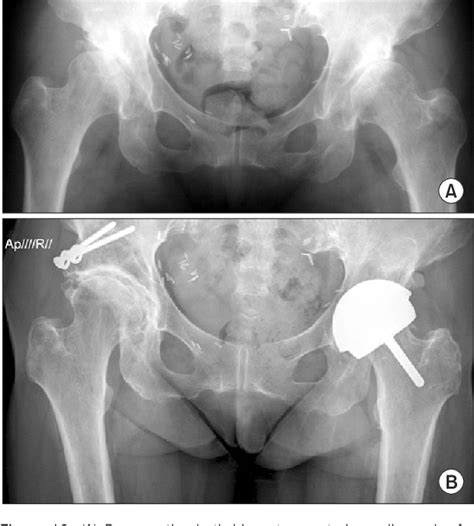 Figure 1 From Pelvic Osteotomy In Adults Semantic Scholar