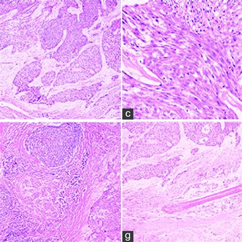 Polymorphous Growth Pattern With Tumor Cells Arranged In Characteristic Download Scientific
