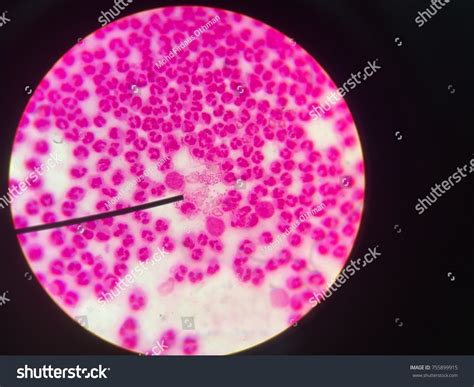 Gram Negative Diplococci