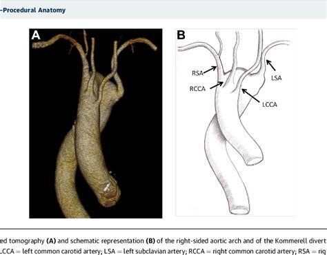 Figure 1 From Double Carotid Subclavian Bypass Followed By Endovascular Exclusion Of A Kommerell