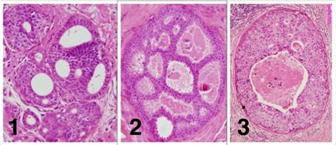 Prognostic Factors And Survival Rates For Ductal Carcinoma In Situ