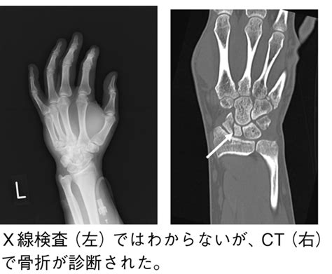 舟状骨骨折｜運動器系の病気（外傷を含む）｜分類から調べる｜病気を調べる｜病気解説2600項目｜根拠にもとづく医療情報の提供｜家庭の医学 大全科