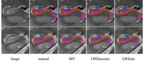 Figure 1 From Multi Atlas Segmentation With Joint Label Fusion Semantic Scholar