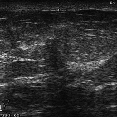 Thickening Of The Skin With Subcutaneous Edema And Interstitial Fluid Download Scientific