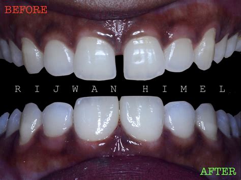 Midline Diastema Closure With Direct Composite Veneer Tooth Fairy