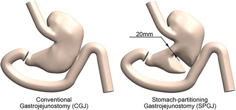 Frontiers Gastric Emptying Performance Of Stomach Partitioning Gastrojejunostomy Versus