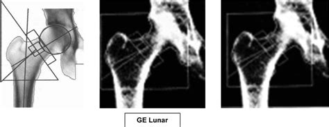 Densitometric Diagnosis Dxa Scans Oncohema Key