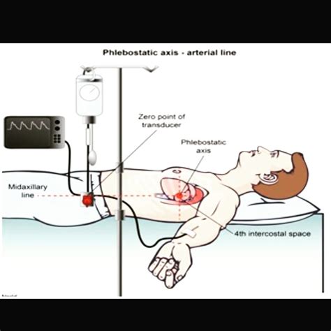Soul Of Rn • The Phlebostatic Axis Is An External Facebook