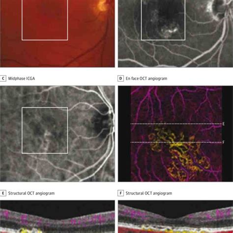 detection of choroidal neovascularization associated with chronic