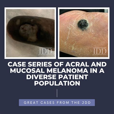 Melanoma Histopathology Archives Next Steps In Dermatology