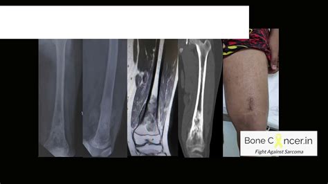 Bone Cancer Osteosarcoma Femur Limb Salvage Surgery Tumor Megaprosthesis Dr Srimanth B S