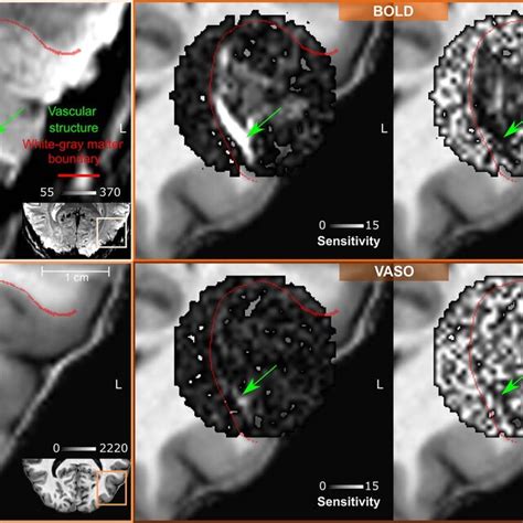 Volume Based Visualization Of Voxel Wise Sensitivity And Specificity