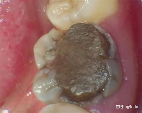 根管治疗后的牙齿崩了怎么办补牙牙冠嵌体持续更新 知乎
