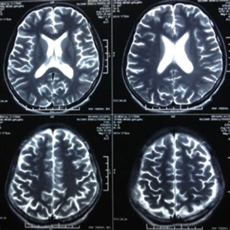 Mri Brain Showing Diffuse Cerebral Atrophy Download Scientific Diagram